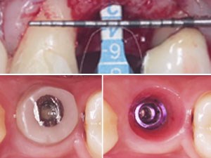 Online Dental CE Webinars And Events | Course - The Implant Supra ...